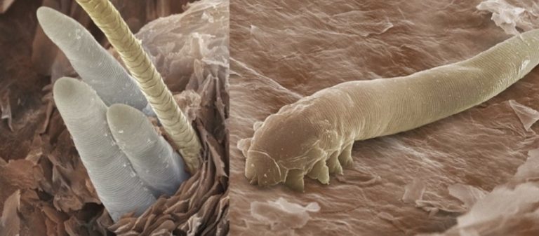 DEMODEX- UN PARAZIT MIC DAR PERICULOS PENTRU SĂNĂTATE - Lovely Looks ...